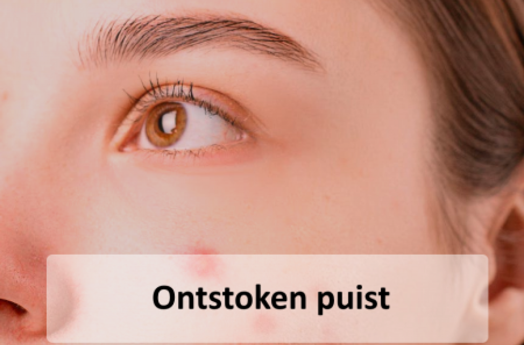 Heb Je Last Van Een Ontstoken Puist Op Puist nl Helpen We Jou Er Vanaf 